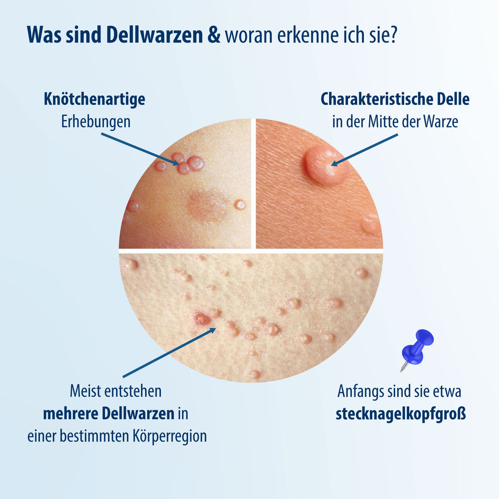 Dellwarzen Mittel – Evolsin-Medical
