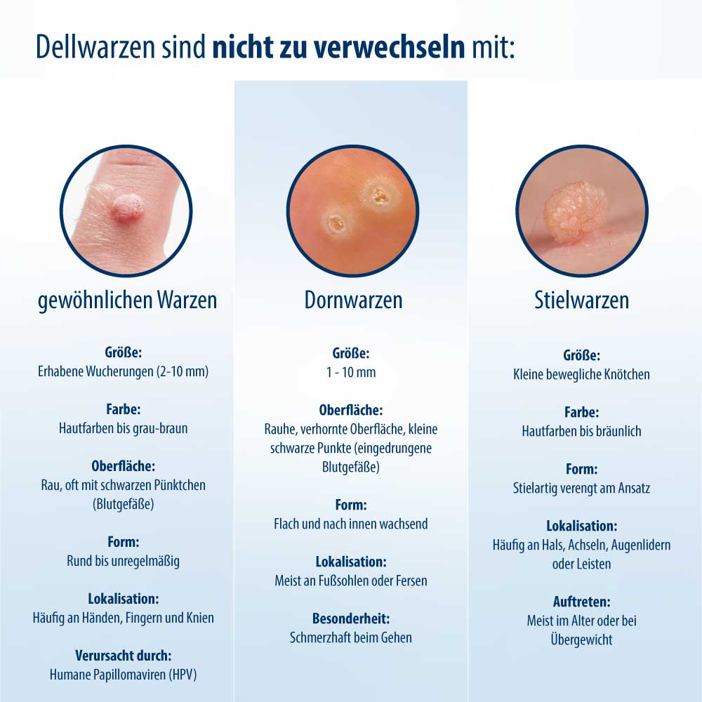 Dellwarzen Mittel – Evolsin-Medical